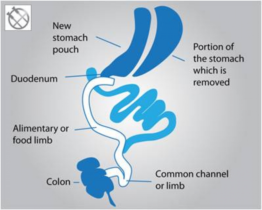 Λαπαροσκοπική χολοπανγκρεατική παράκαμψη - Dr. Ioannis Raftopoulos